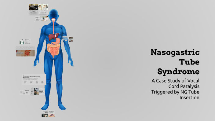 Nasogastric Tube Syndrome by Jennifer Vargas on Prezi