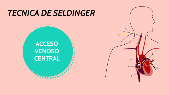 TECNICA DE SELDINGER by Ali Lozano on Prezi