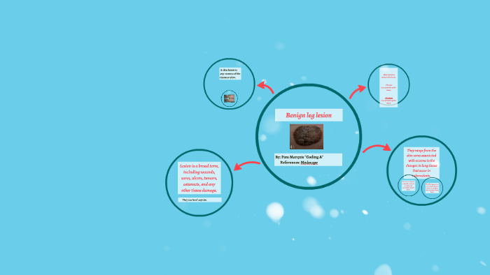 Procedure: Excision of a benign lesion, 5.0 cm on leg with a by Pam ...
