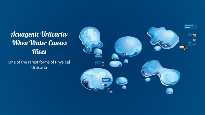 Acuagenic Urticaria: When Water Causes Hives by Anna ... on Prezi