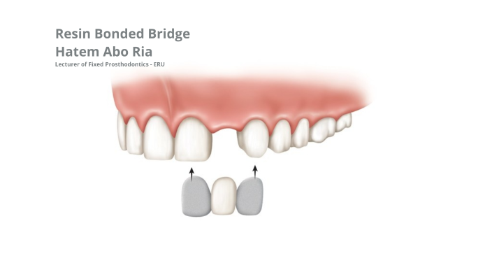 Updated Resin Bonded Bridge by Hatem Abo Ria on Prezi