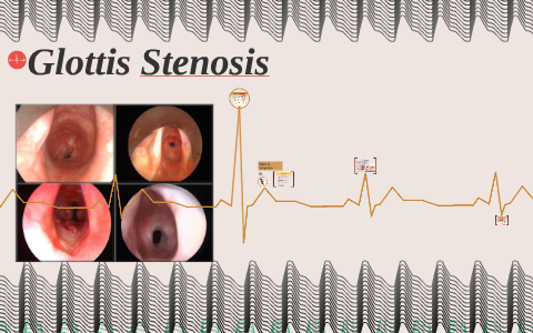 Glottis Stenosis by Joselyn Melgoza on Prezi