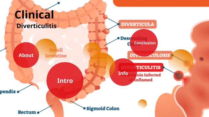 Diverticulitis by Tamirra Johnson on Prezi