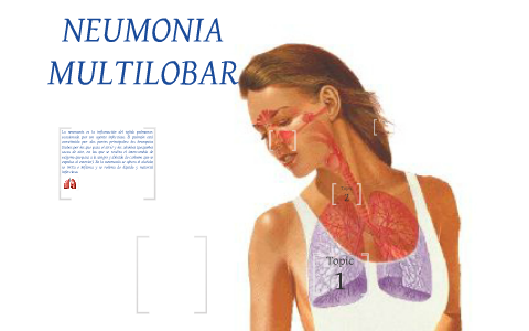 NEUMONIA MULTILOBAR by paola andrea buitrago ocampo on Prezi