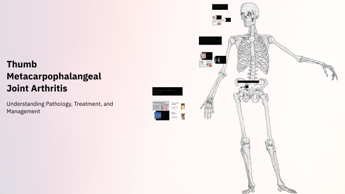 Thumb Metacarpophalangeal Joint Arthritis by Oscar Luis Castro on Prezi