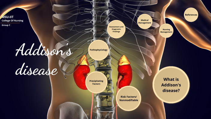 CONCEPT MAP-ADDISON'S DISEASE by Reemah Calib on Prezi