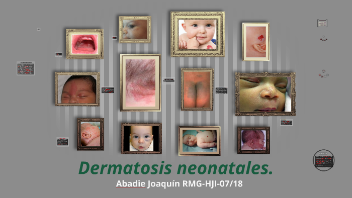 Dermatosis neonatales by Joaquin Abadie on Prezi