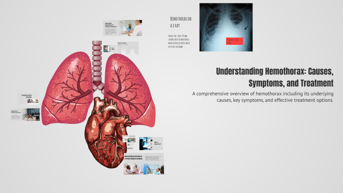 Understanding Hemothorax: Causes, Symptoms, and Treatment by Paris ...