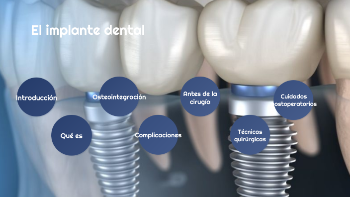 El implante dental by Isabel Martos on Prezi