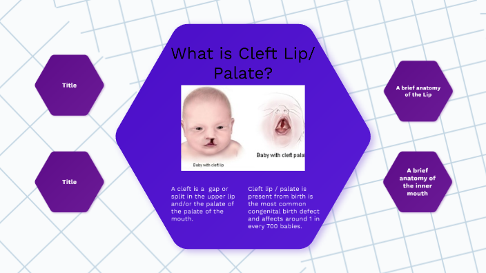 Scars For Life: Cleft Lip and Plate Birth Defect by Hana Farman on Prezi