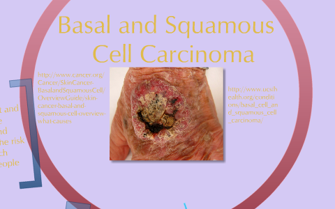 Basal and Squamous Cell Carcinoma by Tyler Barrett on Prezi
