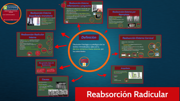 REABSORCION RADICULAR by Abigail Lara on Prezi