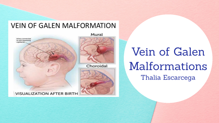 Vein of Galen Malformations by Thalia Escarcega on Prezi