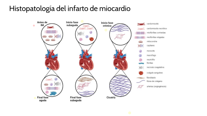 Histopatologia del infarto de miocardio by i b on Prezi