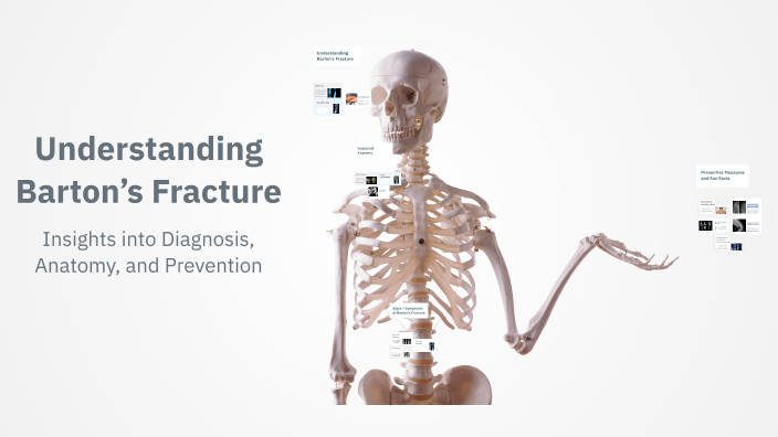Understanding Barton’s Fracture by Noorkamal Sidhu on Prezi