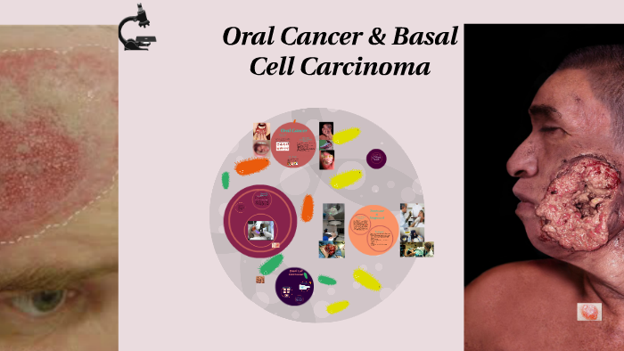 Oral Basal Cell Carcinoma