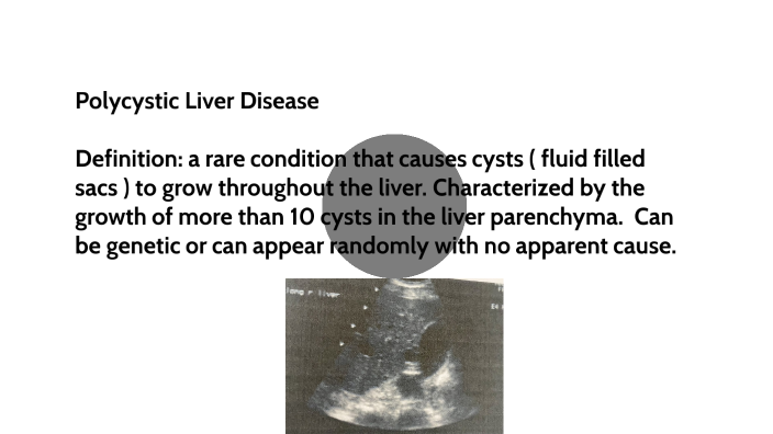 Polycystic Liver Disease by Dashia Primas on Prezi