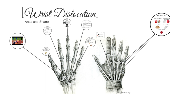 Wrist Dislocation by Anas Eid on Prezi