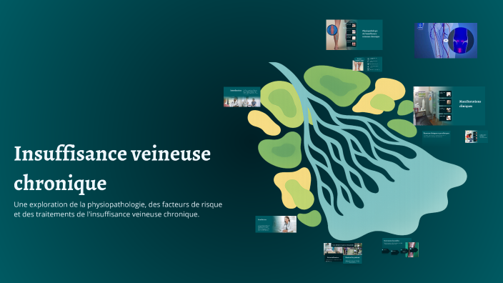 Insuffisance veineuse chronique by SoumSi1 SoumSi1 on Prezi