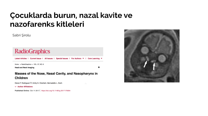 Çocuklarda burun, nazal kavite ve nazofarenks kitleleri by Sabri Şirolu ...