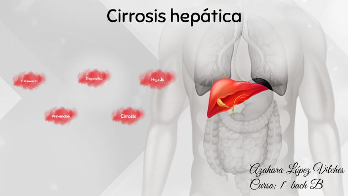 Cirrosis hepática by Azahara López Vilches on Prezi