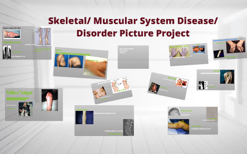 Skeletal/ Muscular System Disease/ Disorder Picture Project by Ashante ...