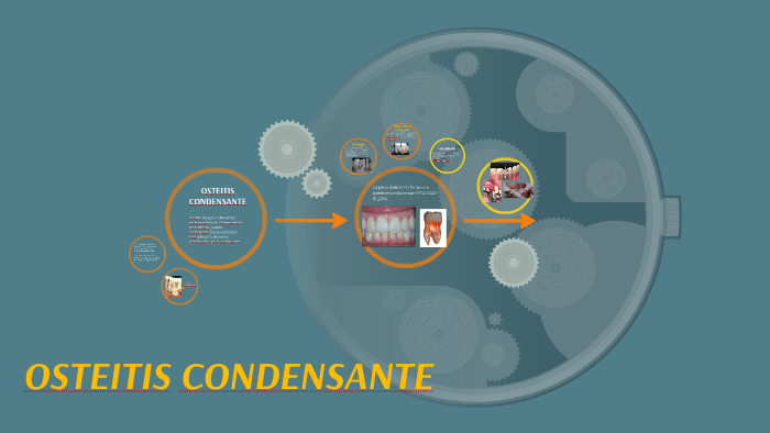 OSTEITIS CONDENSANTE by on Prezi