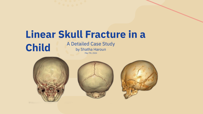 Linear Skull Fracture in a Child by Unable Shay on Prezi