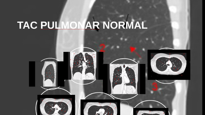 TAC PULMONAR NORMAL by Suany Loor #DS loor on Prezi