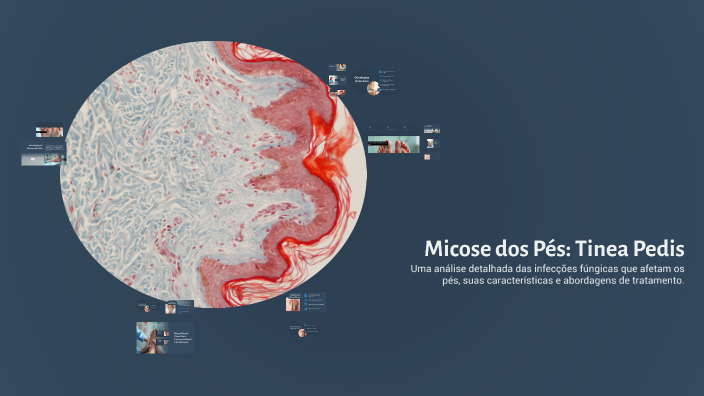 Micose dos Pés: Tinea Pedis by Erik Barretto on Prezi