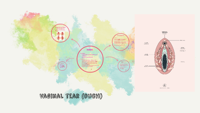 Vaginal tear by stephanie liang on Prezi