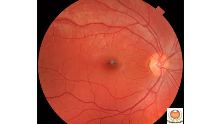 Retinal displacement following successful pars plana vitrectomy for ...