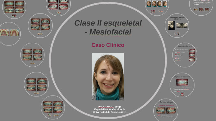 Clase II esqueletal - Mesiofacial by Jorge Laraudo on Prezi