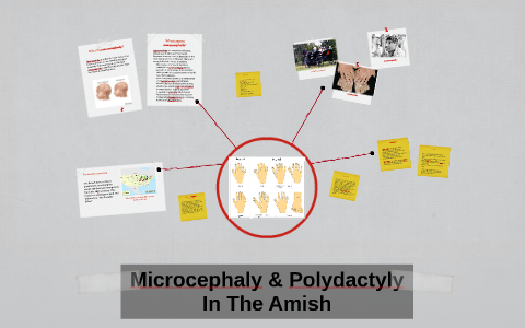 Microcephaly & Polydactyly In The Amish by Nikki Pearce on Prezi