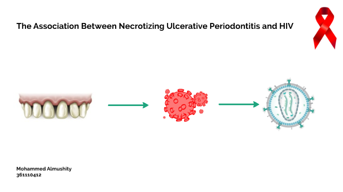 The Association Between Necrotizing Ulcerative Periodontitis and HIV by ...