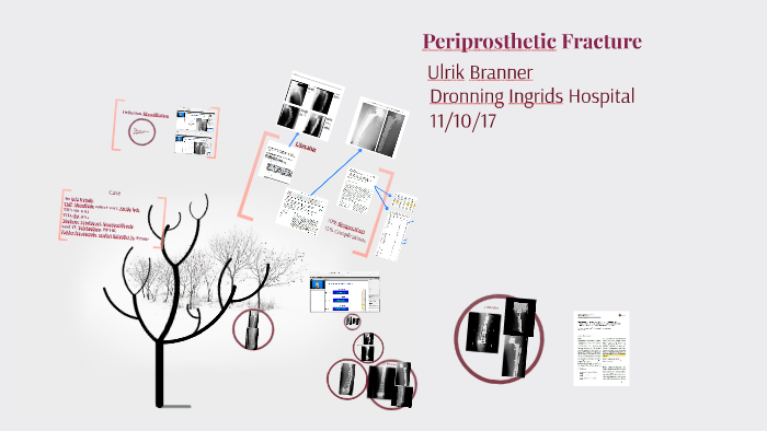 Periprosthetic Fracture by Ulrik Branner on Prezi