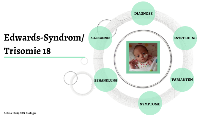 Edwards Syndrom by Selina Hirt on Prezi