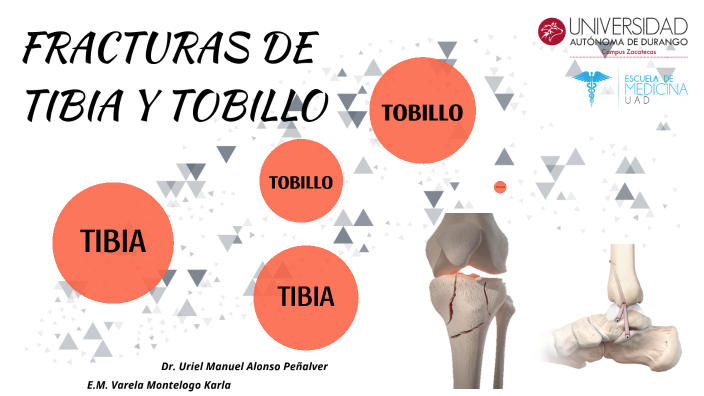 Fractura de tibia y tobillo by Karla Varela on Prezi