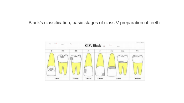 Black’s classification, basic stages of class V preparation by Nana ...