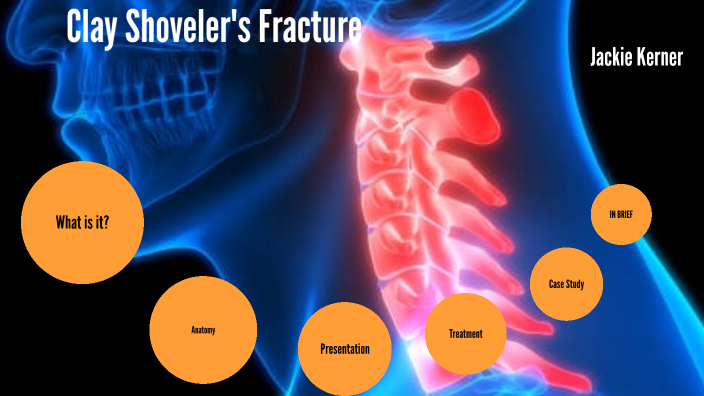 Clay Shoveler's Fracture by Jaclyn Kerner