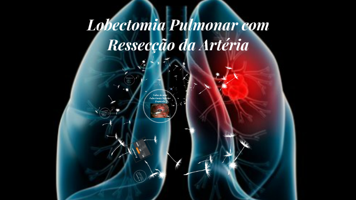 Lobectomia Pulmonar com ressecção da artéria by Elsa Miranda on Prezi