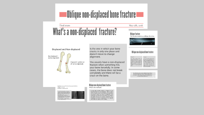 Oblique non-displaced bone fracture by Mariano Coronado on Prezi