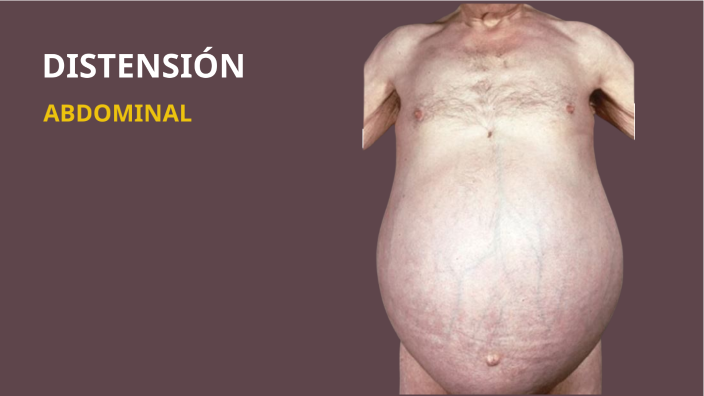 DISTENSIÓN ABDOMINAL by NEIZA DANIELA JAILLITA AVILES on Prezi