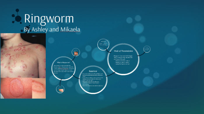 Ringworm by Ashley Darrell on Prezi