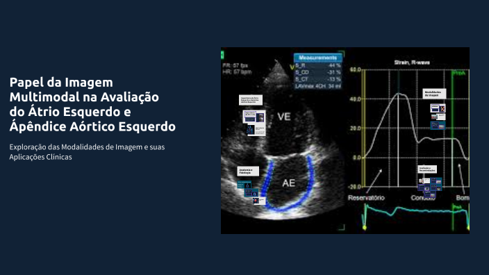 Papel da Imagem Multimodal na Avaliação do Átrio Esquerdo e Ápêndice ...