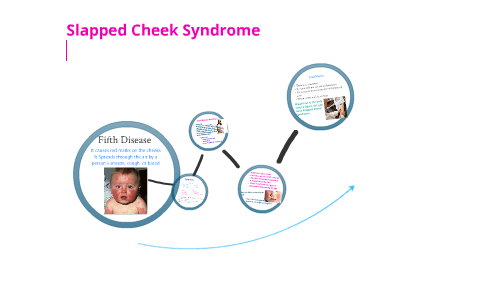 Slapped cheek Syndrome[] by 25Mexico 89lpn on Prezi