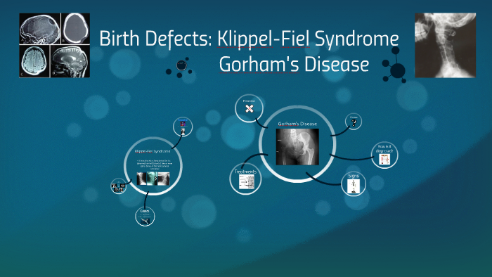Birth Defects: Klippel-Fiel Syndrome by Shaige-Lee Werth on Prezi