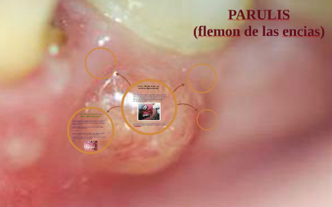 PARULIS by Lucia Melgar on Prezi