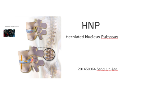 HNP ;Herniated Nucleus Pulposus by Sang hoon Ahn on Prezi