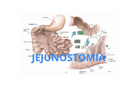 Jejunostomia by Pedro Thiébaut on Prezi